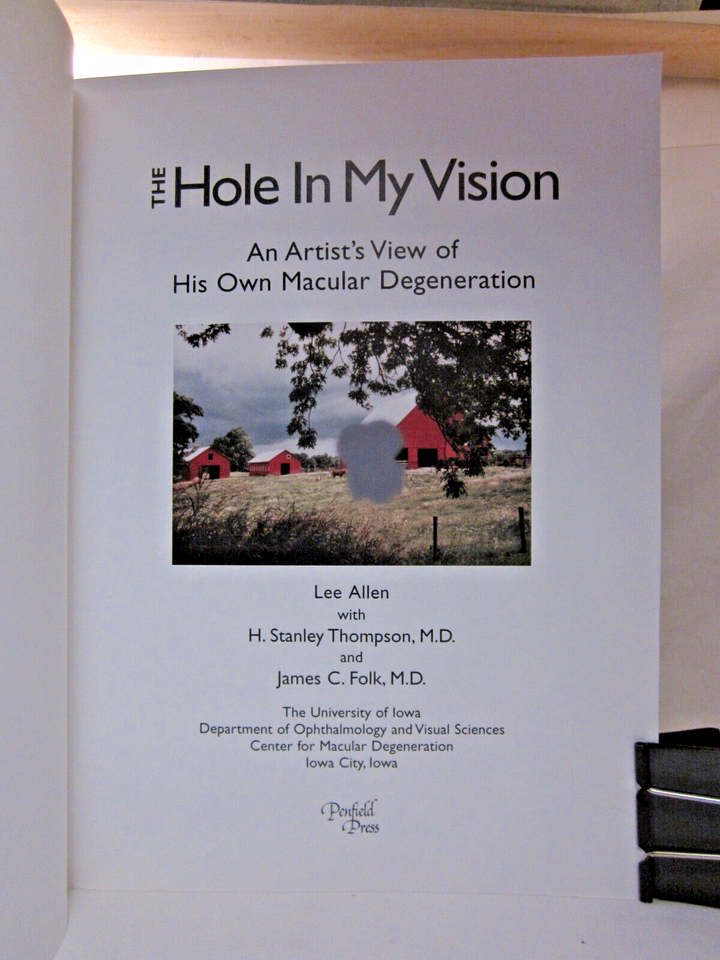 Hole in My Vision : Watching My Own Age-Related Macular Degeneration by ...
