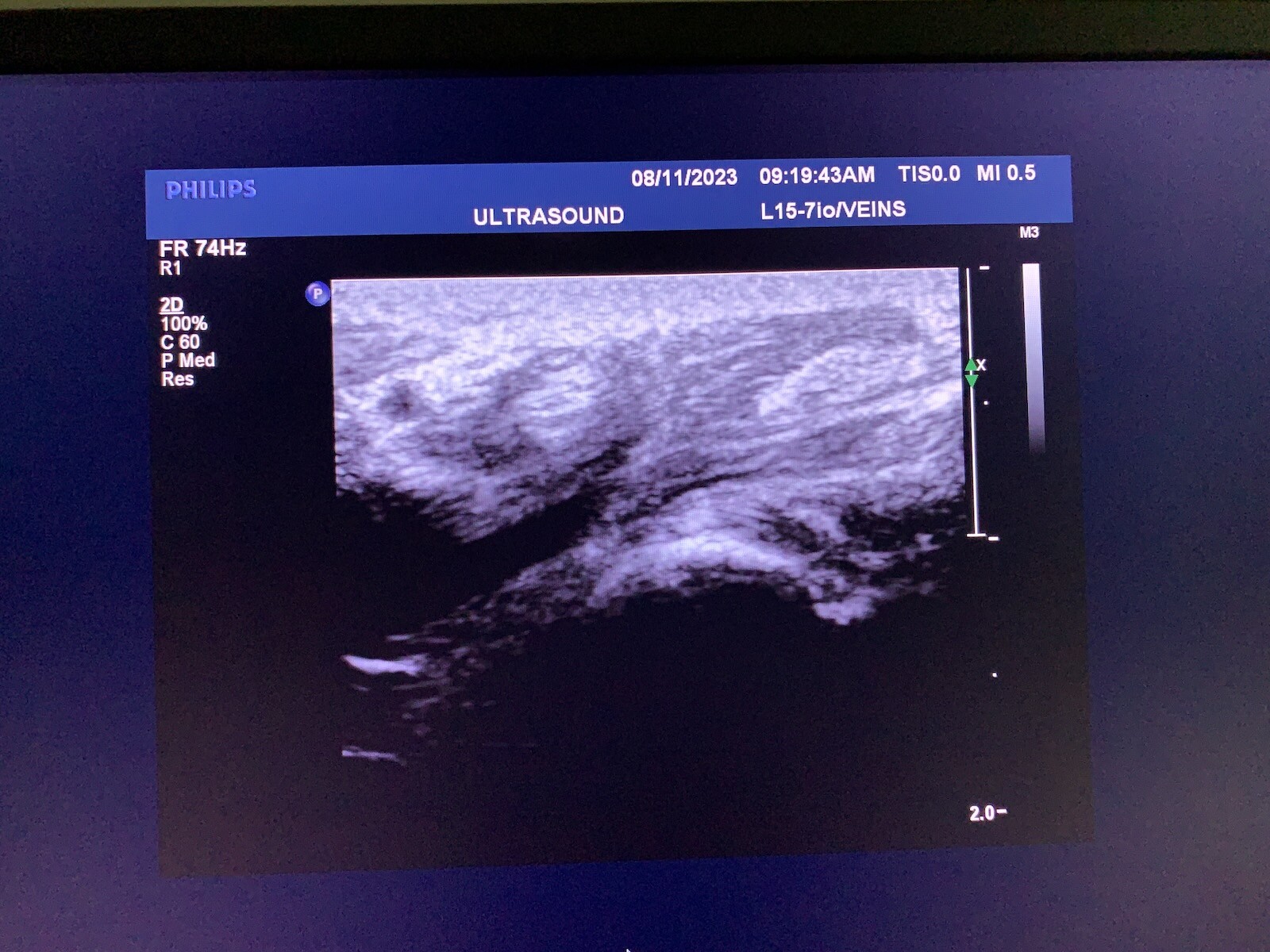 Philips L15-7io Linear Array Hockey Stick Ultrasound Transducer Probe ...