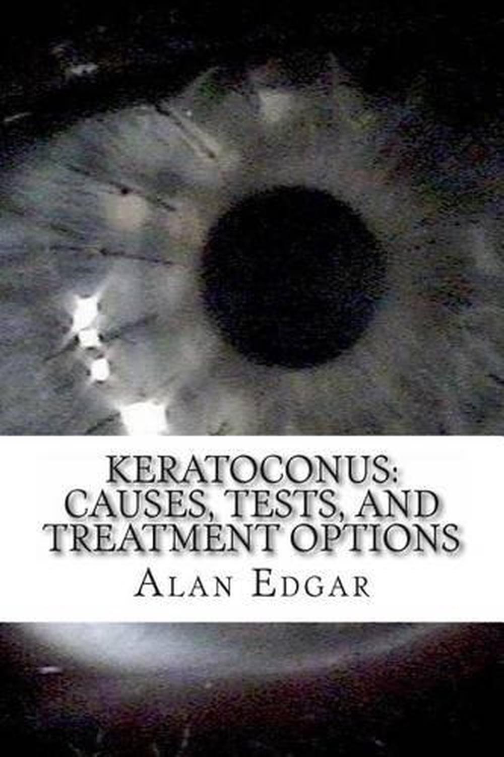 Keratoconus: Causes, Tests, and Treatment Options by Alan Edgar Ma ...