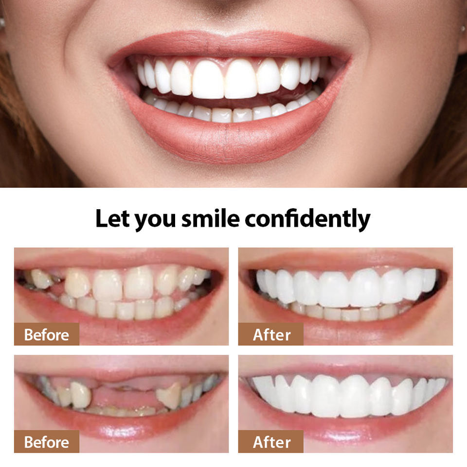 Teeth Veneers Whitening Dentures Braces Temporary False Teeth Smile ...