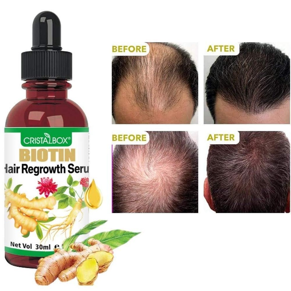 5 Pack Ginger Hair Growth Serum, Biotin Hair Regrowth Oil for Men and ...