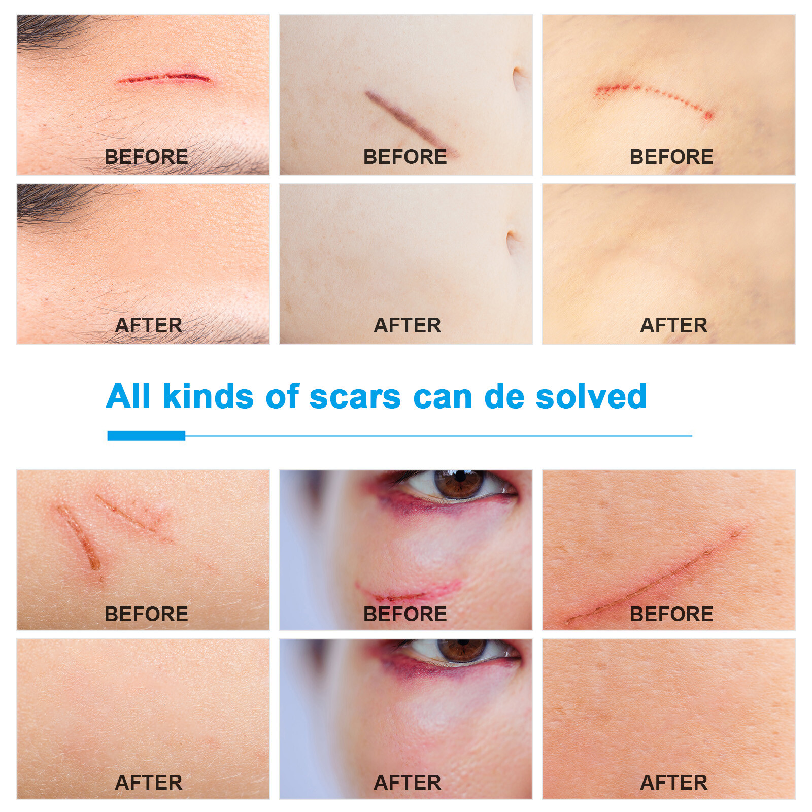 Adhesive Silicone Scar Patch Safety Mild Fade Scar Scar Reduction ...