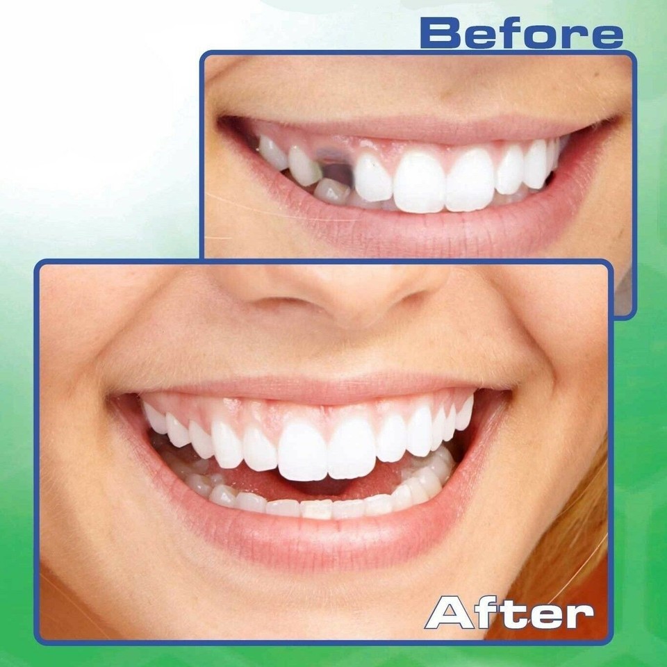 Instant Smile Temporary Tooth Kit 10 False Teeth Cosmetic Fake ...