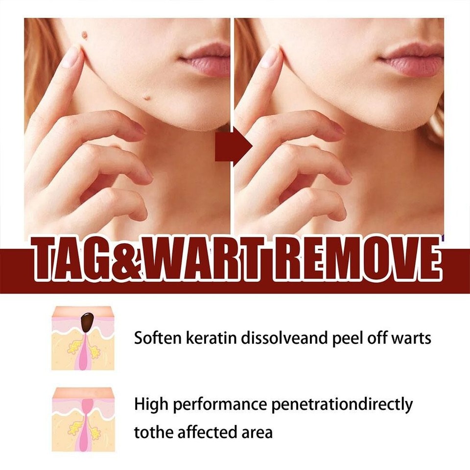 Wipe Off Skin Tags Moles Wart Remover Liquid Pen Fast Effect Genuine ...