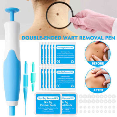 2-8 mm Auto Micro Skin Tag Remover Device Kit Safe Painless Removal ...