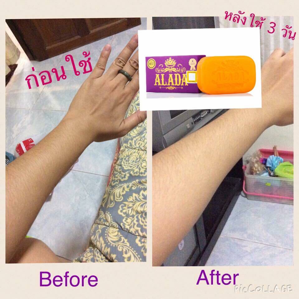 ALADA Super Fast Whitening Skin x10 Soap & Booster Lotion Set (USA 🇺🇸 ...