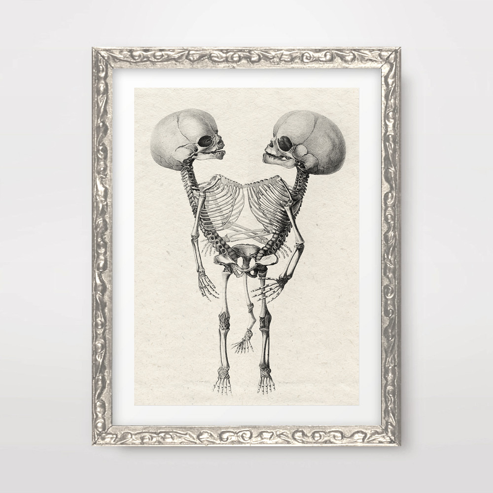 Conjoined Twin Skeleton