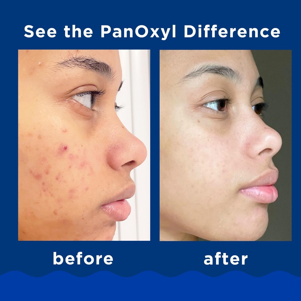 PanOxyl Acne Foaming Wash Benzoyl Peroxide 10% Maximum Strength ...