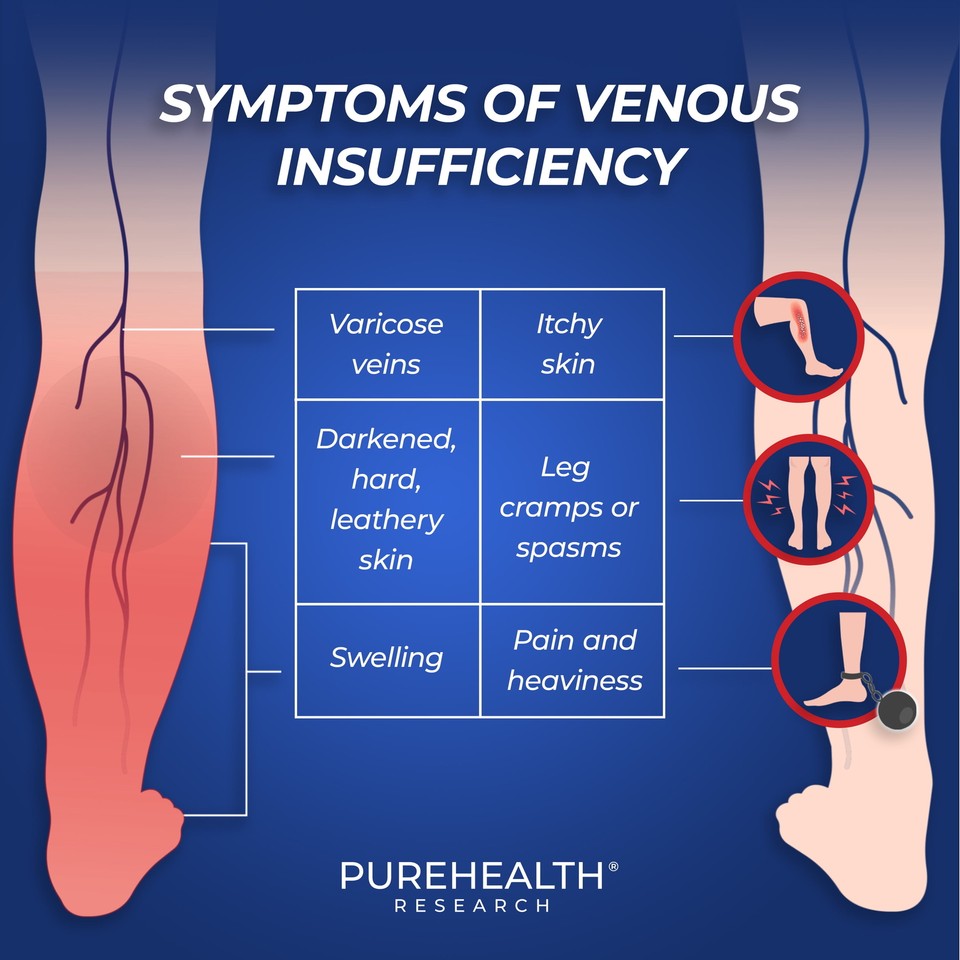 PureHealth Research Venease - Varicose Veins and Hemorrhoids Blood ...