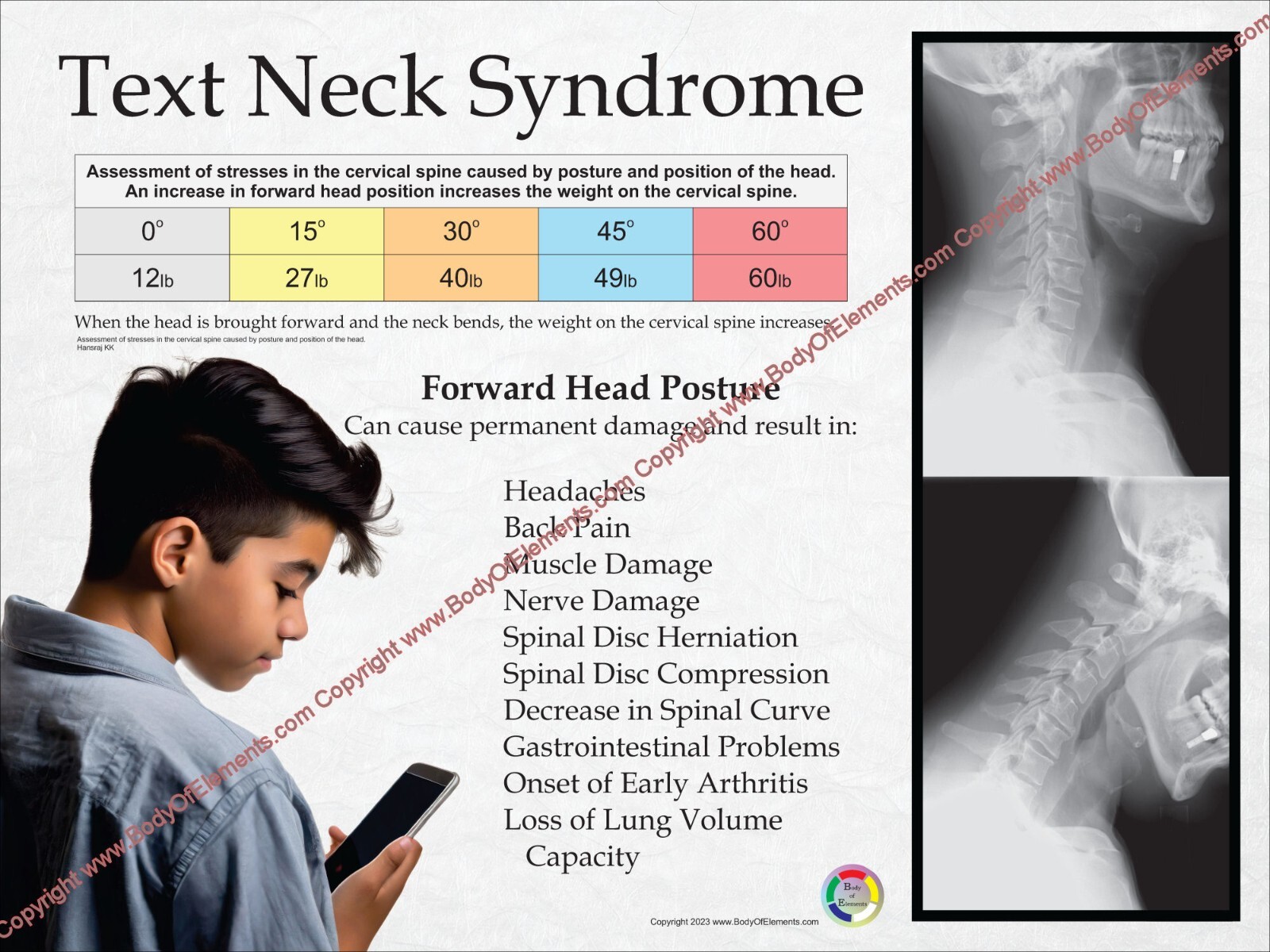 Text Neck Syndrome Poster Forward Head Neck Pain 18" X 24" Chiropractic ...