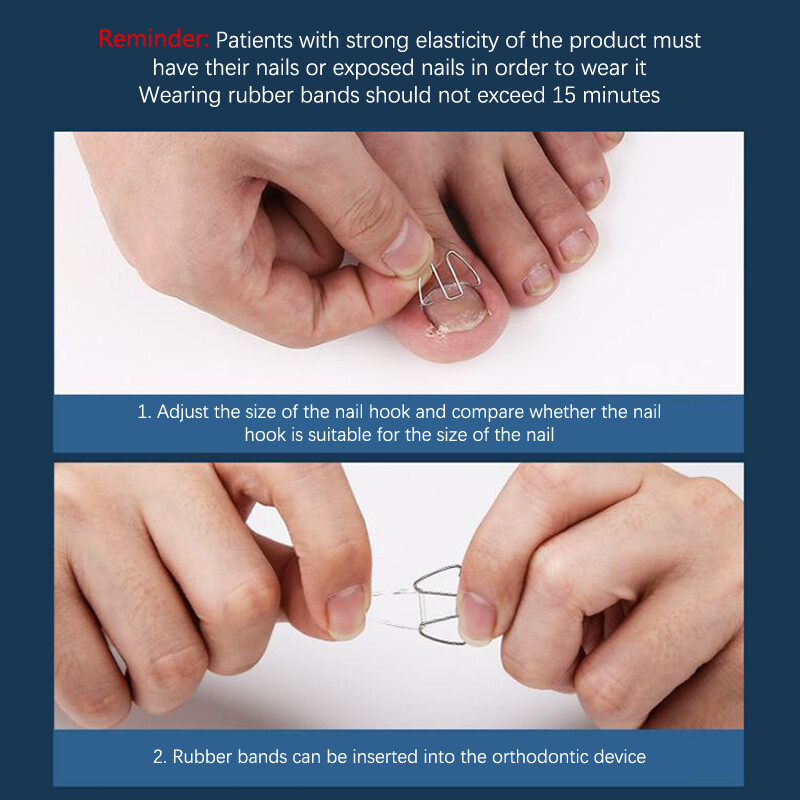 Ingrown Toe Nail Correction Hook/Steel Wire Paronychia Orthosis ...