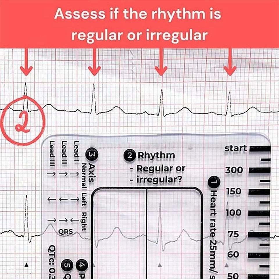 2pcs ECG 7 Step Ruler,ECG 7 Step Ruler for ECG/EKG Interpretation ...