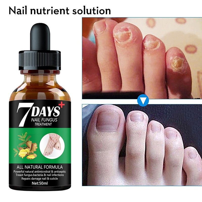 7DAYS Nail Fungus Treatment Serum Care Hand and Foot Care Removal 50ml ...
