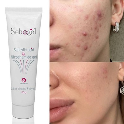 Sebogel Salicylic Acid & Nicotinamide Gel For Pimples And Oily Skin ...