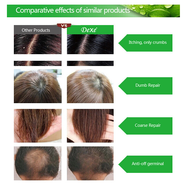 200 Dexe Shampoo Anti Hair Loss Chinese Herbal Induce Regeneration ...