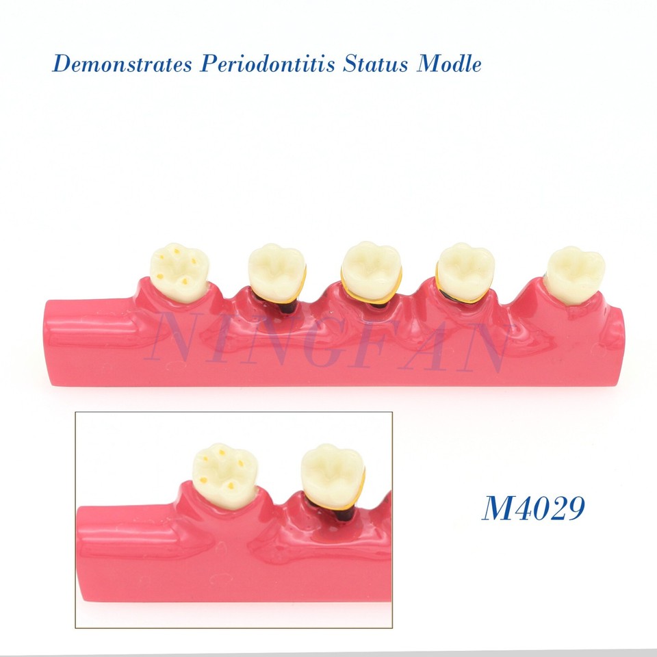 Dental Study Teaching Model Periodontal Disease Assort Teeth Dentoform ...