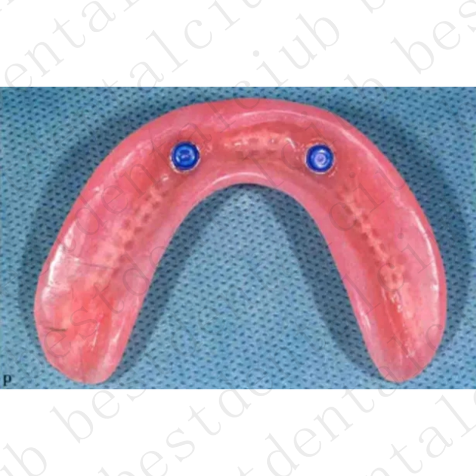 10Kits Dental Overdenture Locator Abutments Retention Caps Implant ...