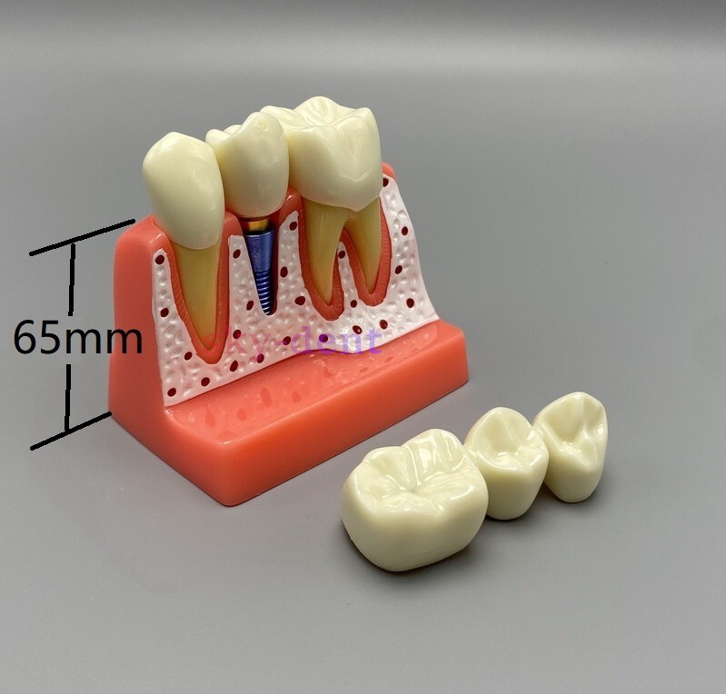 Dental Typodont Teeth Model Ortho Implant Pathological Perio Practice ...