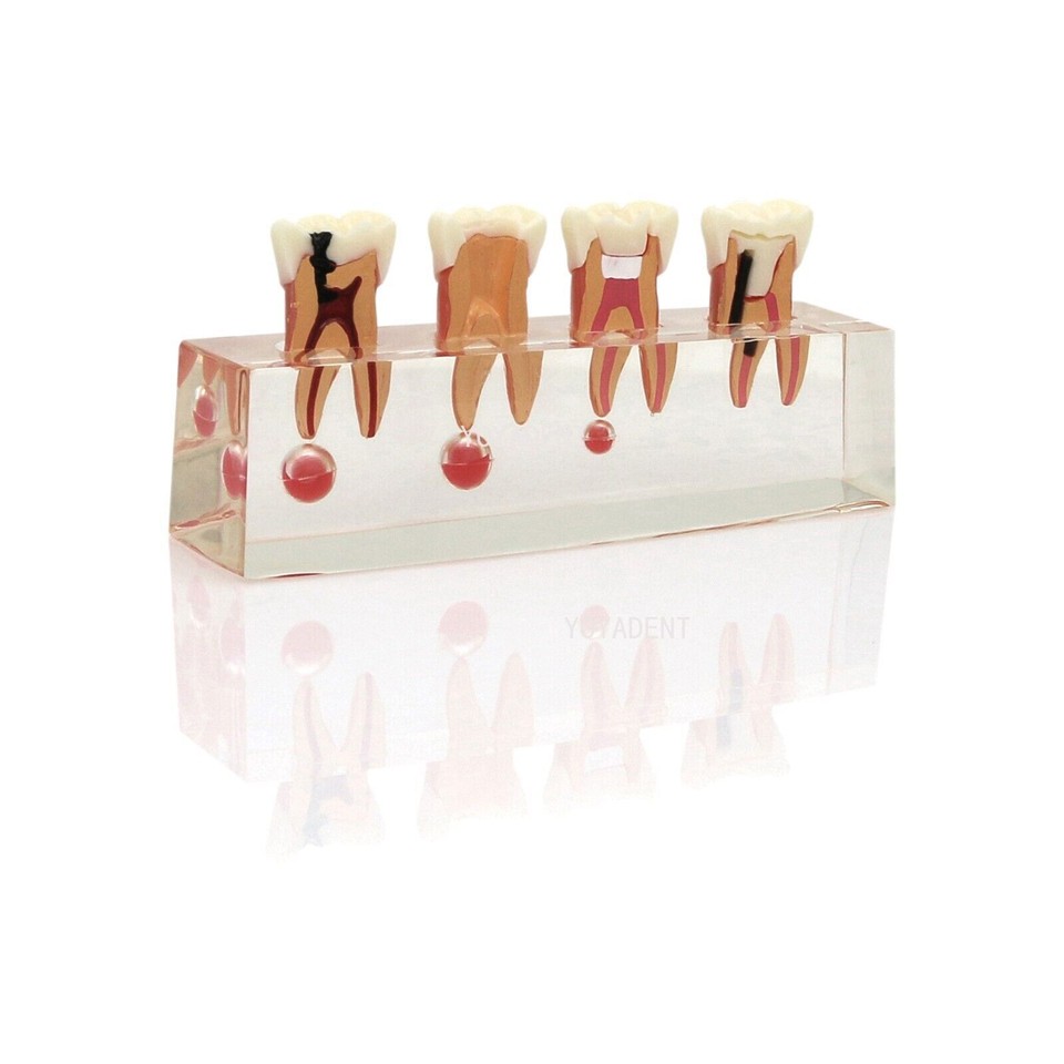 Dental Teeth Model Periodontal Disease Assort Model Endodontic Teaching ...