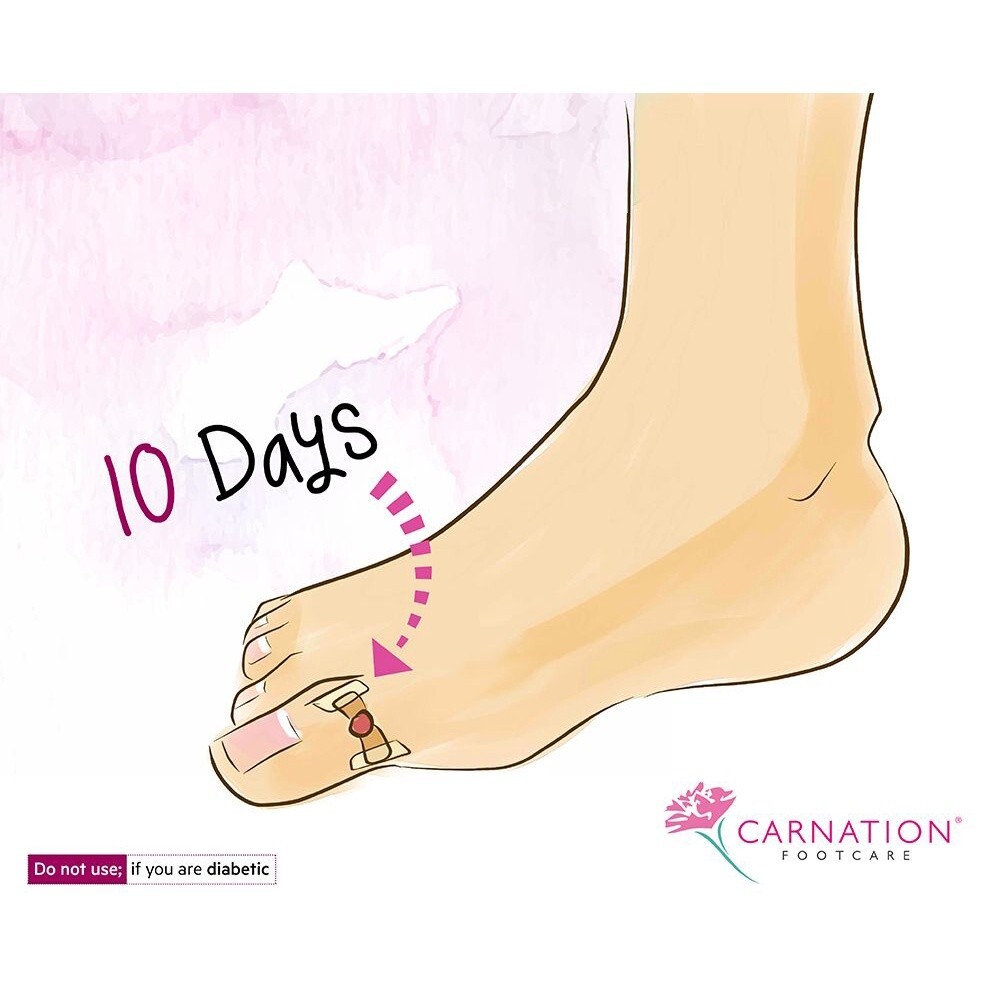 (24x 5's) Carnation Corn Caps Medicated Footcare Plasters - EXPEDITED ...