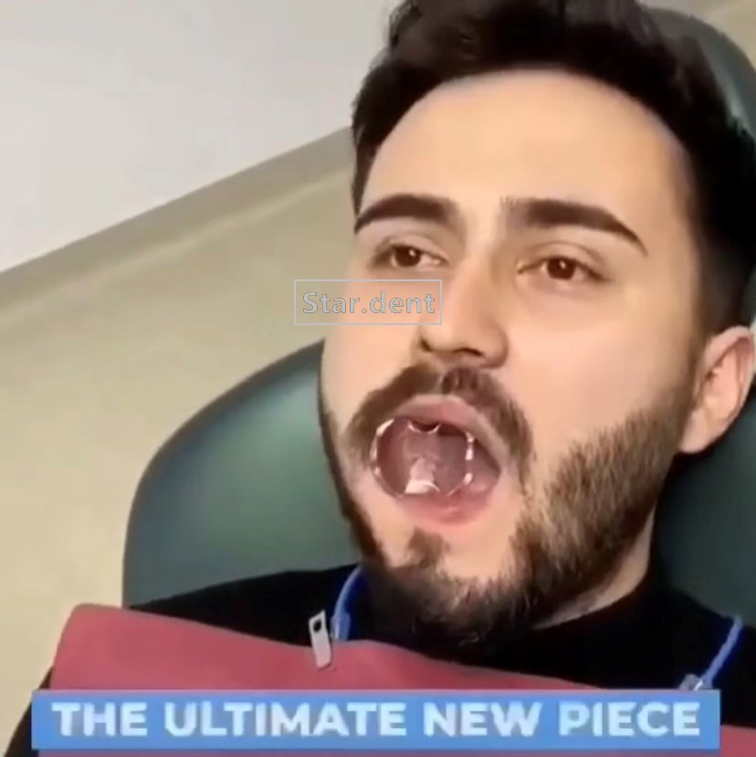 Dental Endo Mouth Opener Cheek Retractor Expander Bite Props Anterior ...