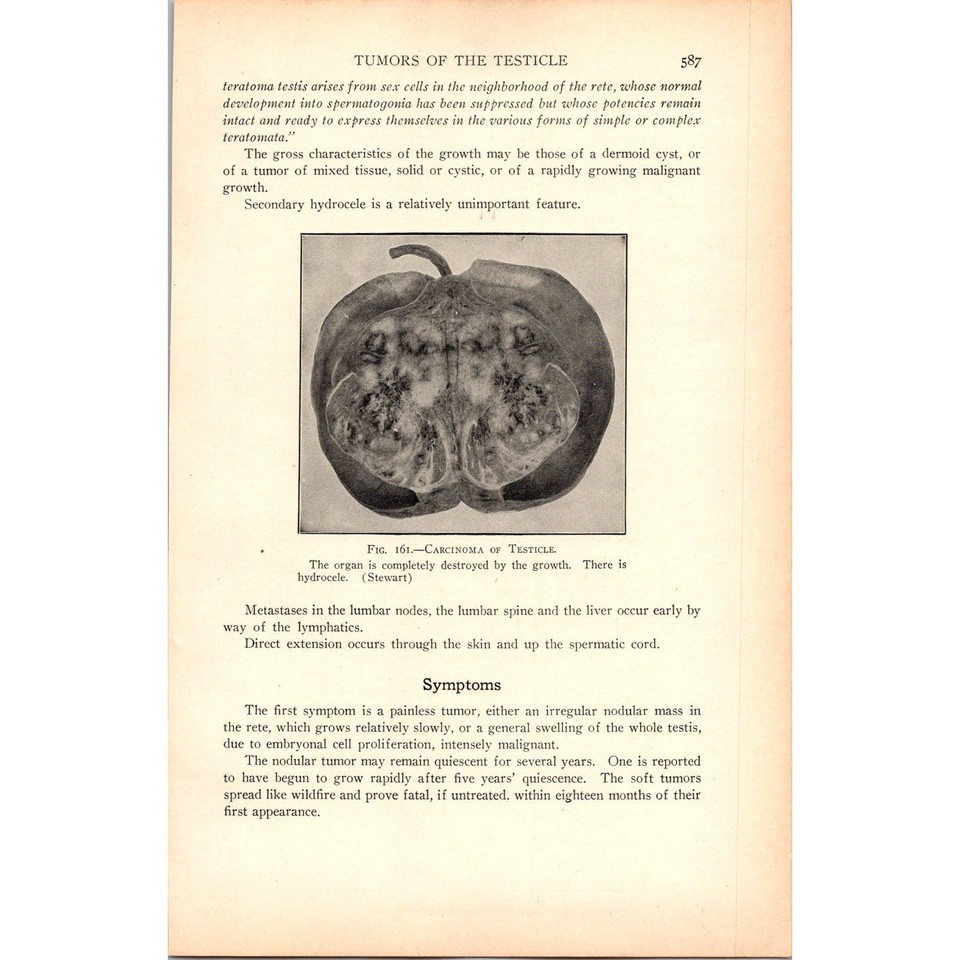 Tumors Of The Testicle Teratoma Testis 1928 Urology Book Plate Print ...
