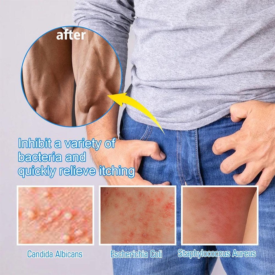 Men Private Intimate Cream 20g for Men Balanitis Repair Itching Relie ...