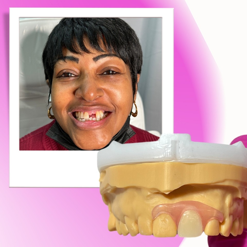 Nesbit, Flexi Flipper, Molar Flipper, Missing Canine Tooth, Flipper ...