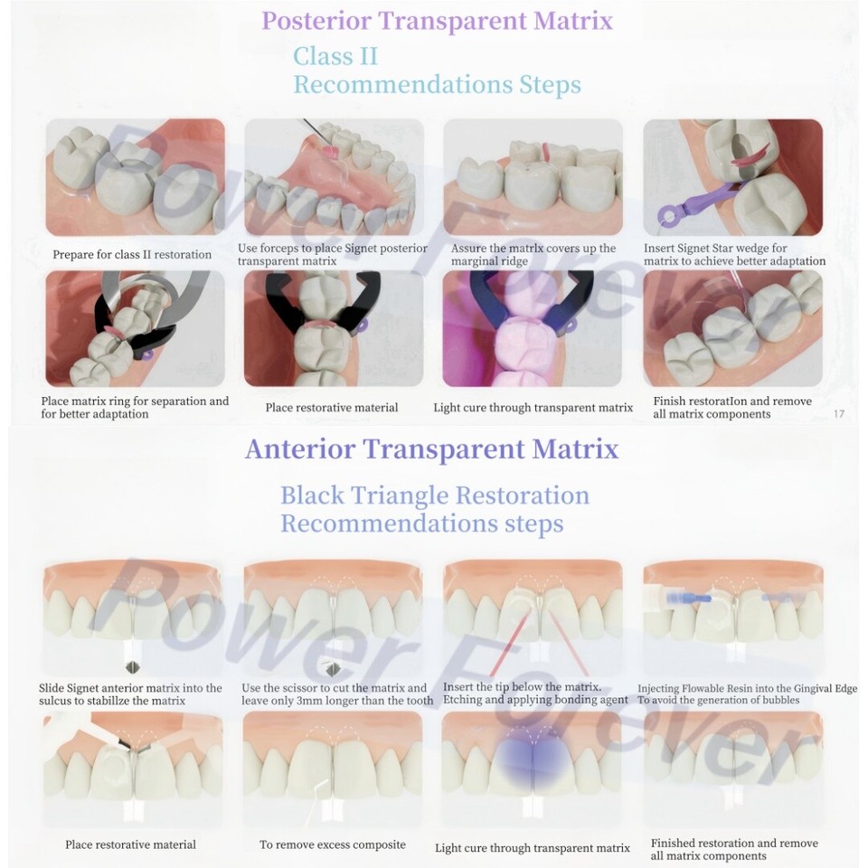 Dental Clear Matrix Diastema BT Matrices Wedges Similar with BioClear ...