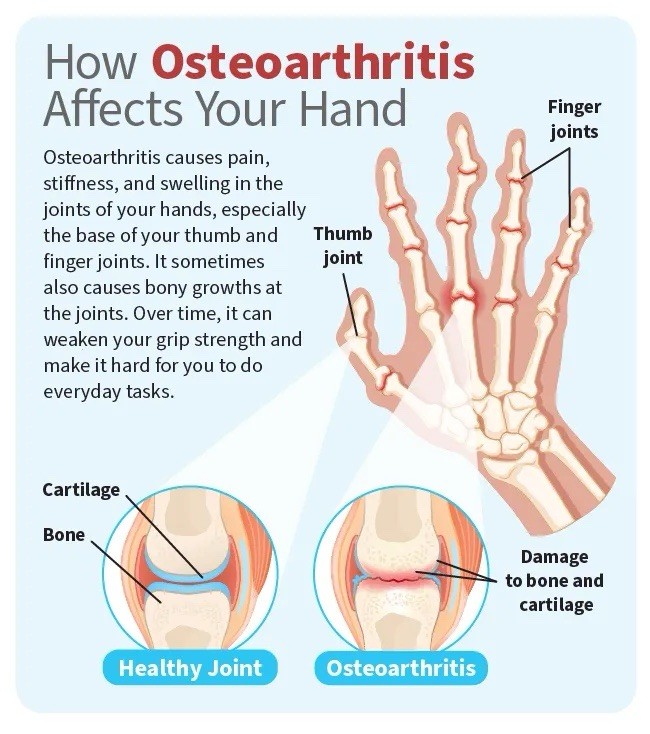 High-Strength Arthritis Formula, Osteoarthritis & Rheumatoid TREATMENT ...
