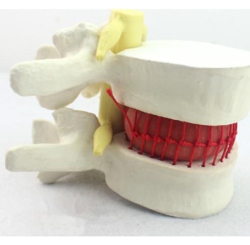 Lumbar Vertebra Slipped Disc Human Anatomical Medical Demonstration ...