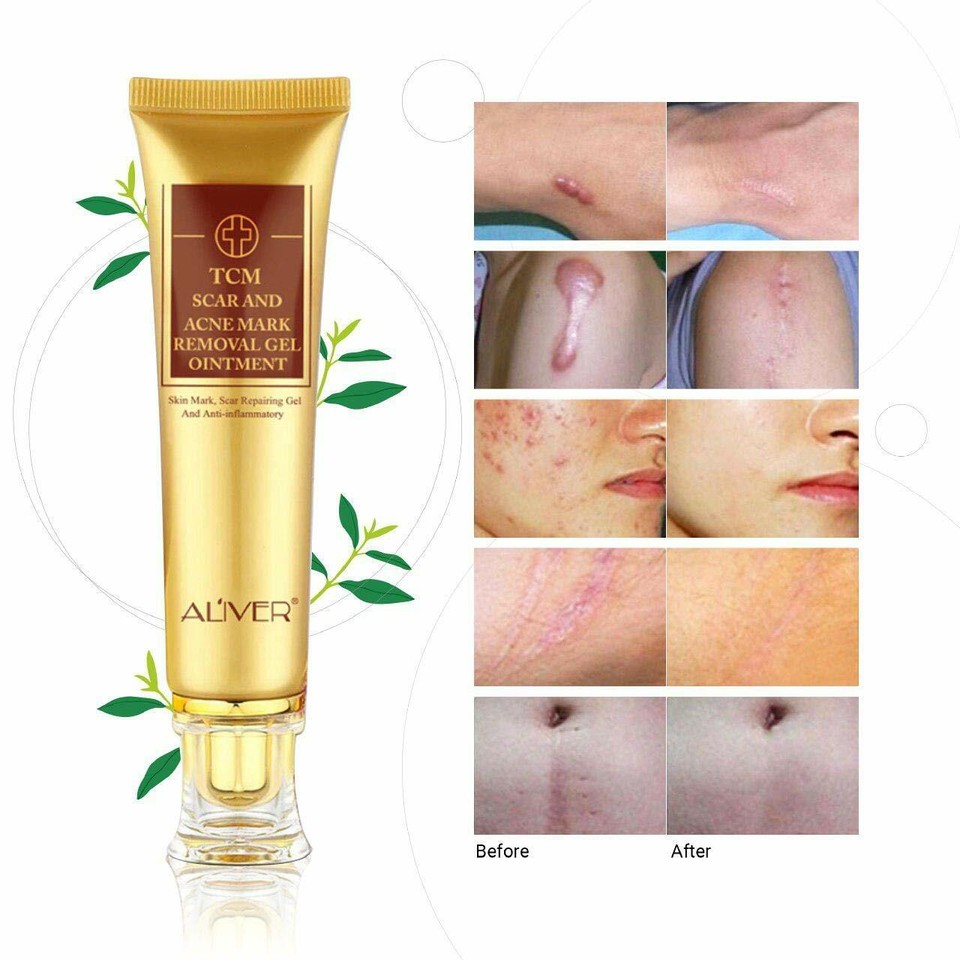 ALIVER TCM SCAR AND ACNE MARK REMOVAL GEL OINTMENT Acne Scar Burns ...