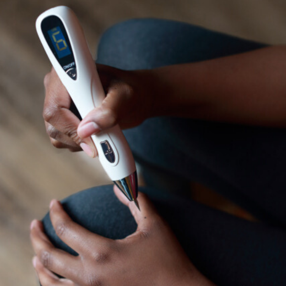 Mole Removal Dark Spot Skin Tag Tattoo Wart Remover Pen BOGO Free By ...