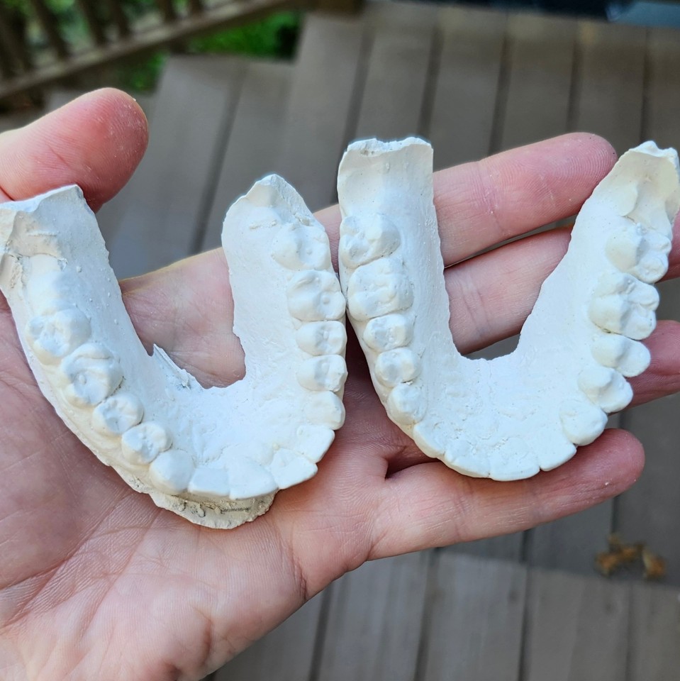 Dental Casting Of Human Teeth Plaster Impressions Both Upper/Lower Jaw ...