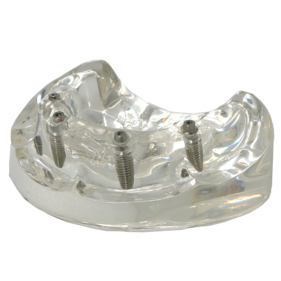 Dental Implant All-on-4 overdenture treatment Model with titanium frame ...