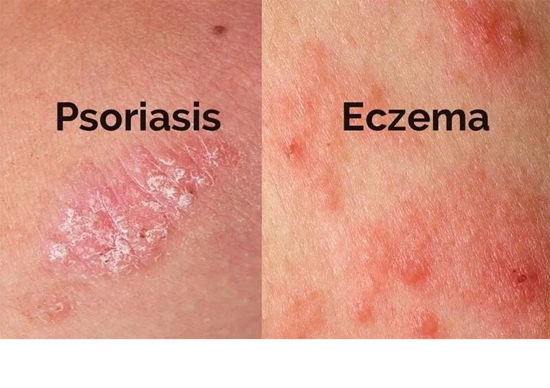 Coal tar & Salicylic Acid Topical Ointment 50g- Hair & Scalp Psoriasis ...