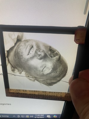 Antique Medical GLASS SLIDE Photo PLASTIC SURGERY Gunshot Face eye #17 ...