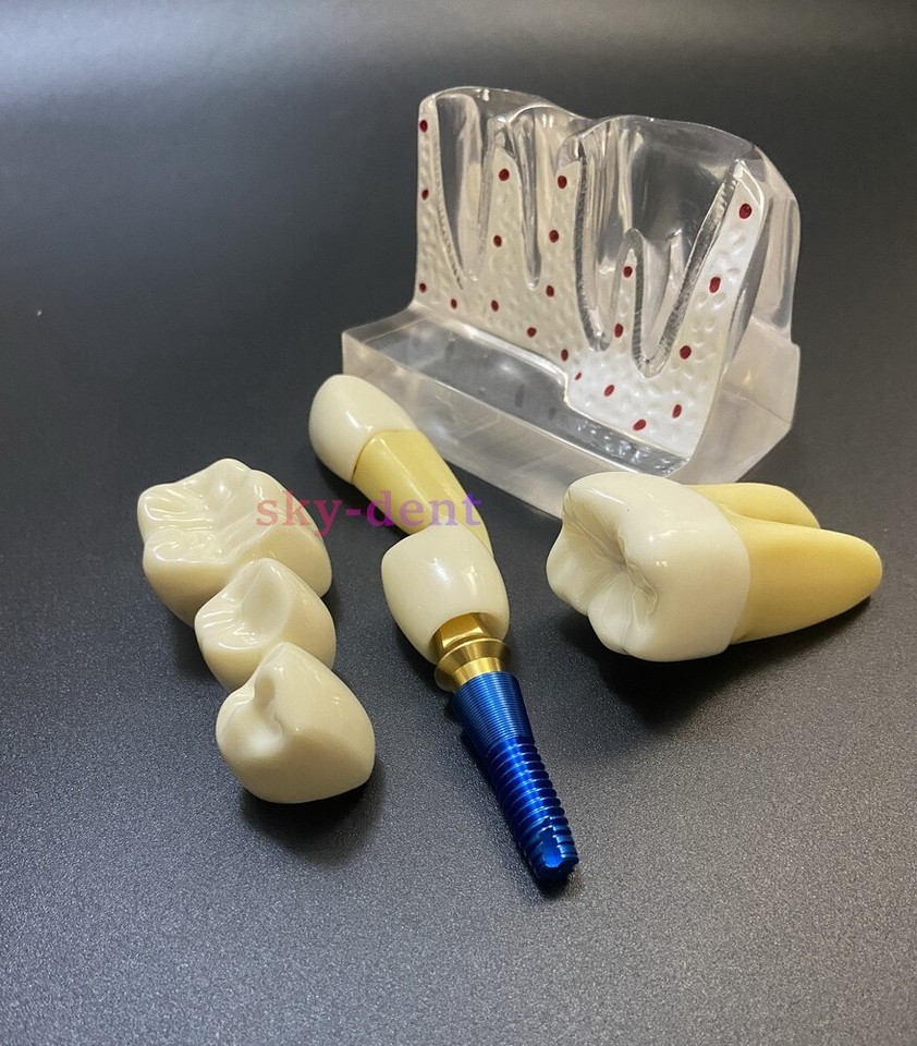 Dental Typodont Teeth Model Ortho Implant Pathological Perio Practice ...