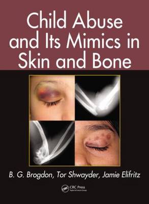 Child Abuse and its Mimics in Skin and Bone by Tor Shwayder, B. G ...