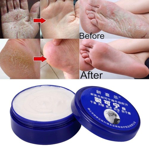 80ml Chilblain Frostbite Inflammation Warming Cream H8A9 Effective ...