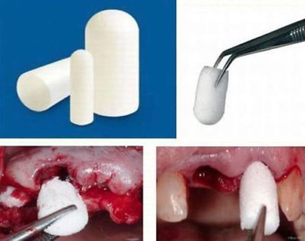 10 x COLO PLUG RESORBABLE PURE COLLAGEN SPONGE Oral Application Dental ...