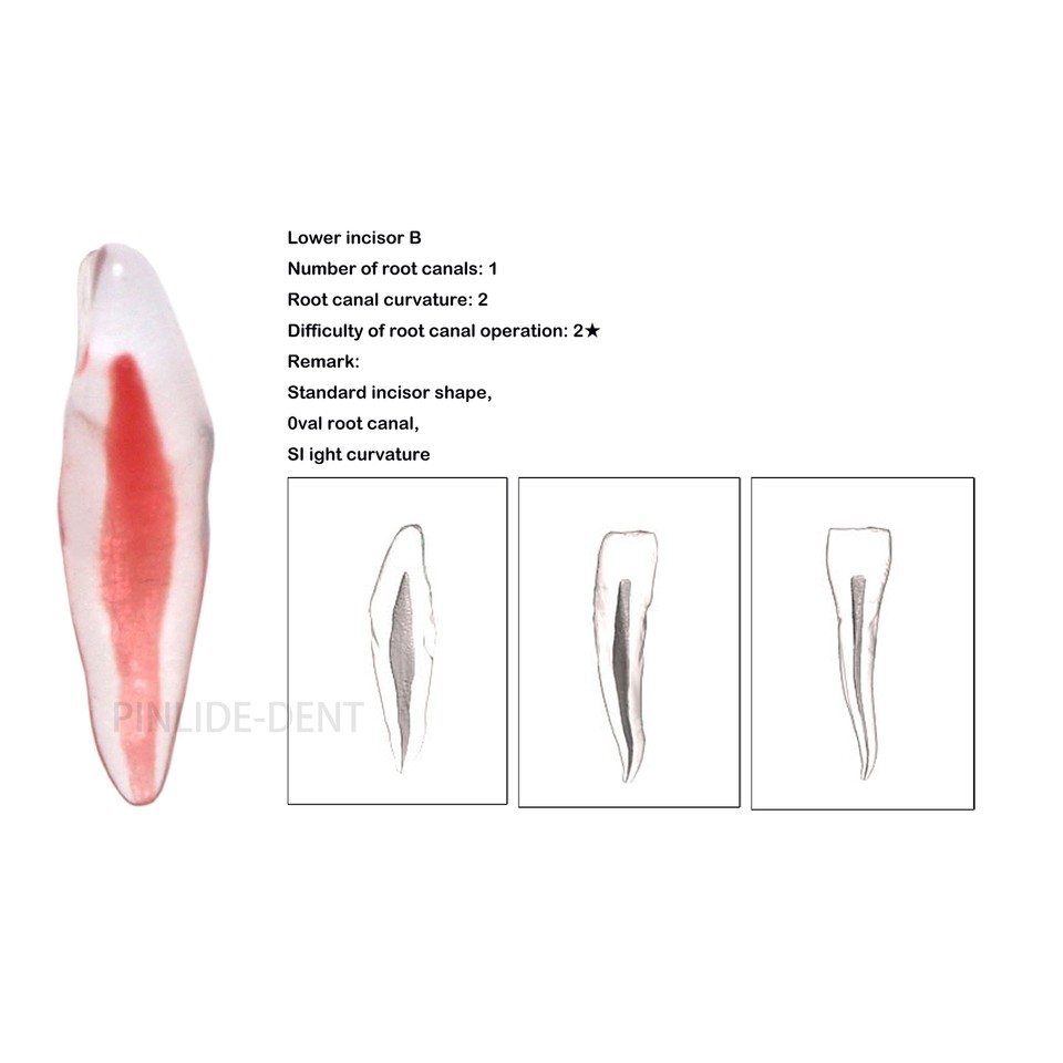 Dental Resin Root Canal Teeth Model Endo Practice Block RCT Pulp Cavity ...