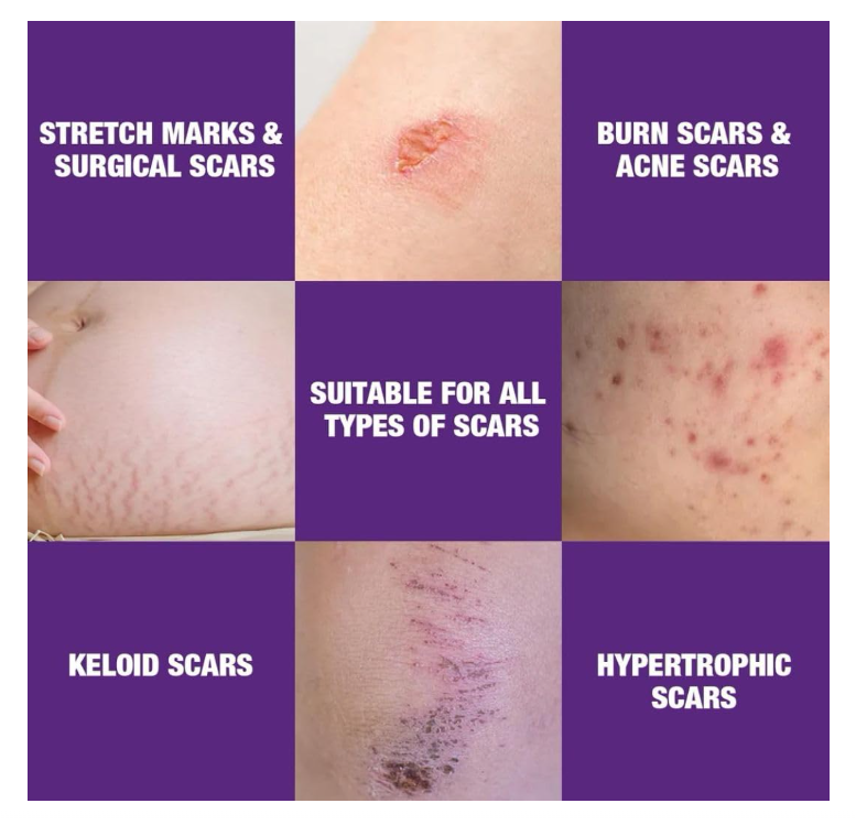 Scar Cream,Scar Gel,Scar Cream For Surgical Scars,Scar Removal Cream ...