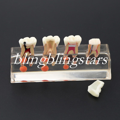 Dental Teeth Model Treatment Demonstrates Model 4 Stages Endodontic ...
