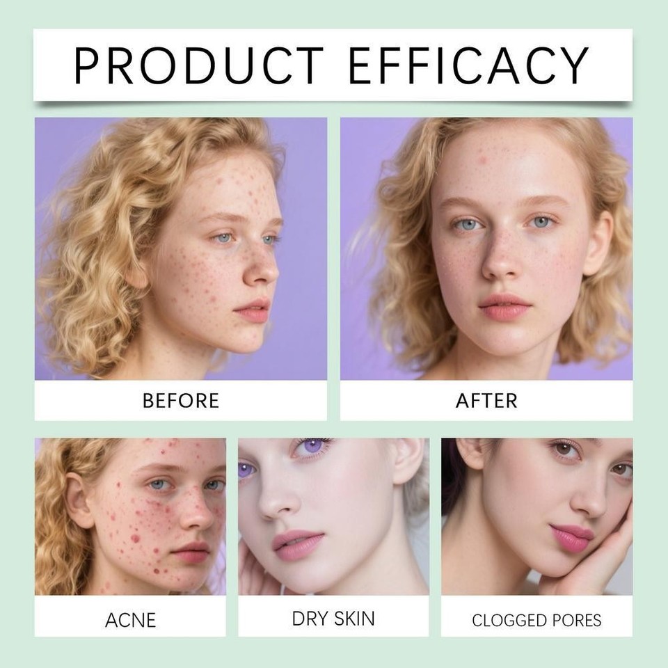 Anti-Acne Cream Effectively Removes Skin Nodules Pustules Papules ...