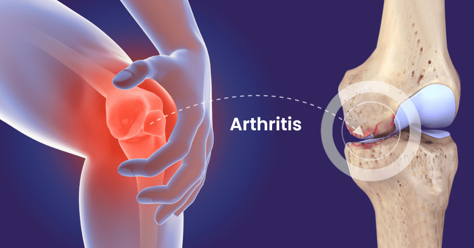 High-Strength Arthritis Formula, Osteoarthritis & Rheumatoid TREATMENT ...