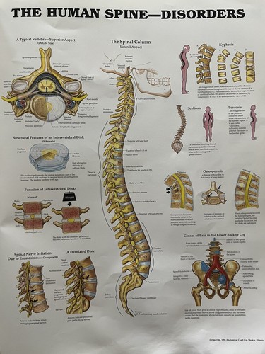 The Anatomical Chart ~ The Human Spine-Disorders ~ 11.25 x 14 Poster | eBay